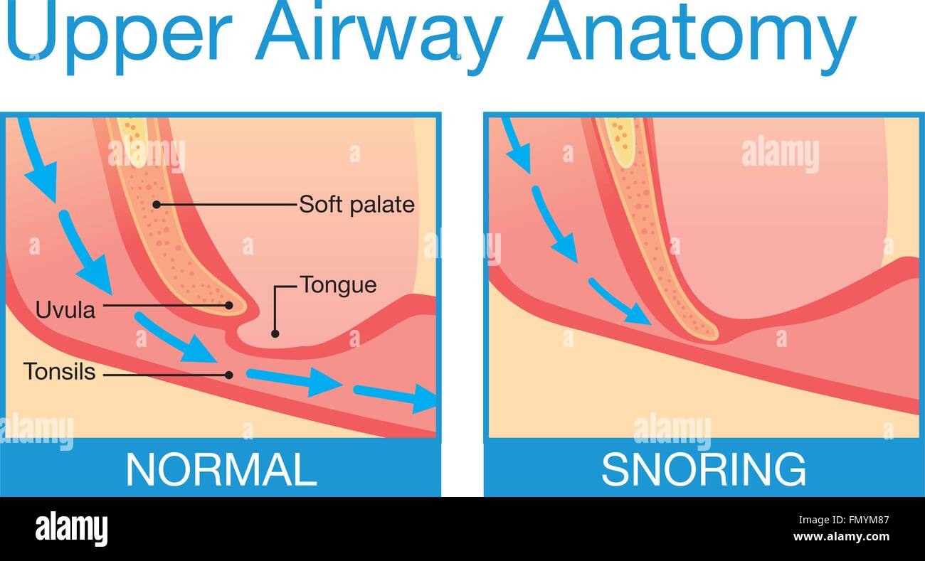 Oberen Atemwege Anatomie in normal schlafen und Schnarchen Stock ...