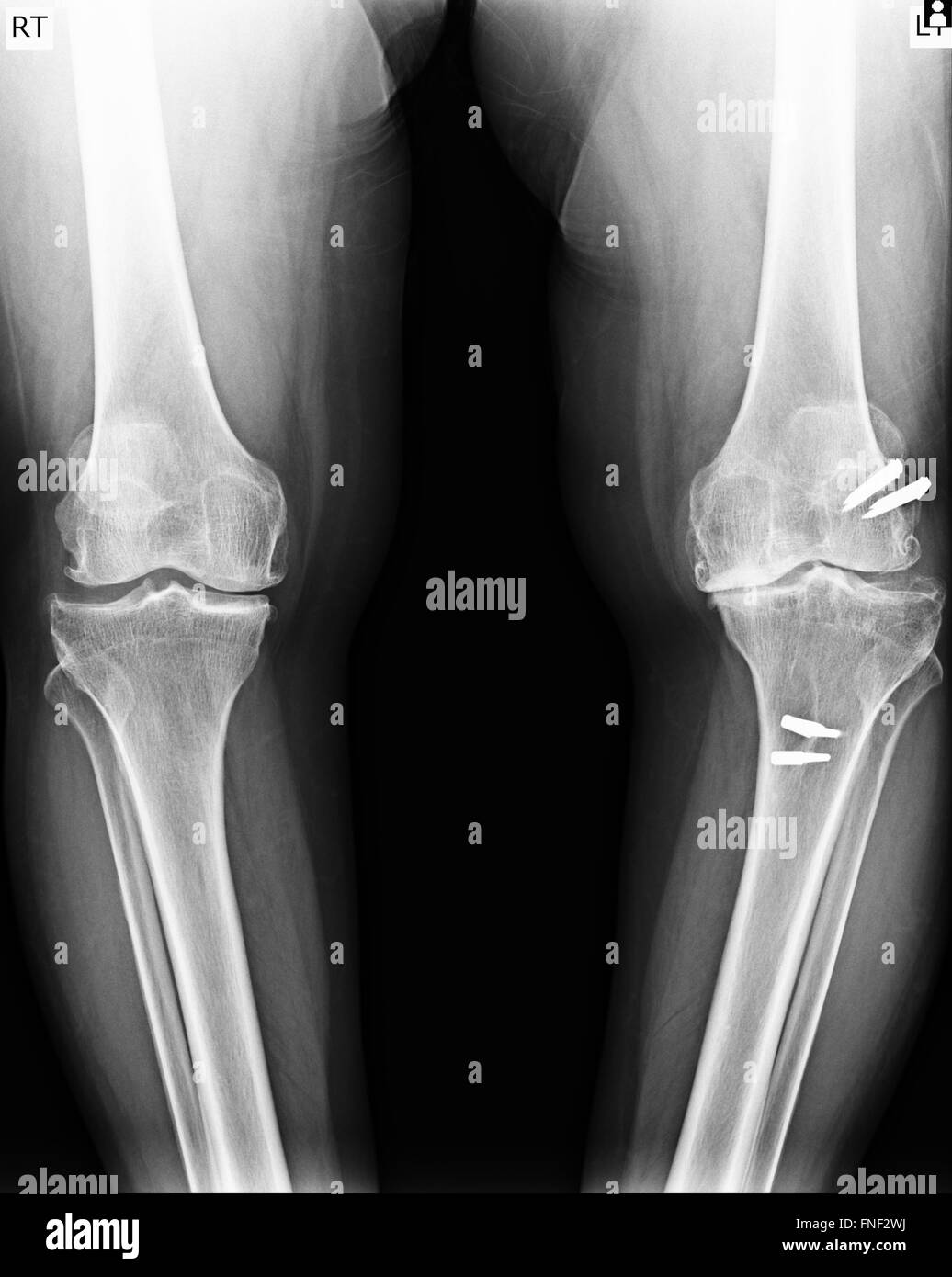 Anatomie des knies Schwarzweiß-Stockfotos und -bilder - Seite 2 - Alamy