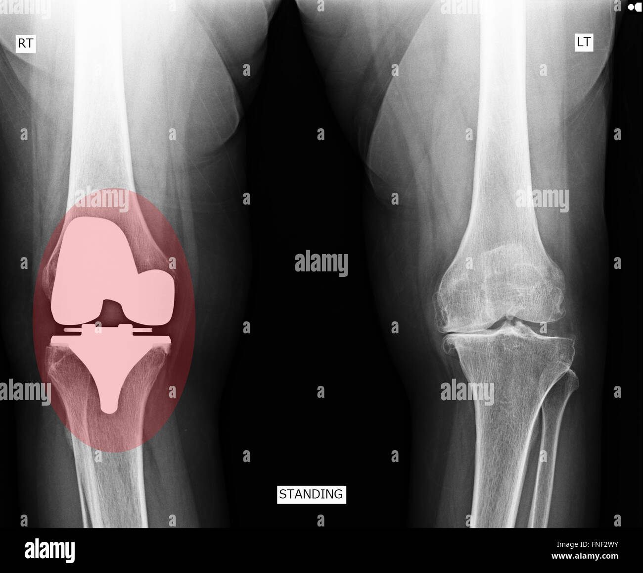 Knee replacement -Fotos und -Bildmaterial in hoher Auflösung - Seite 2 ...