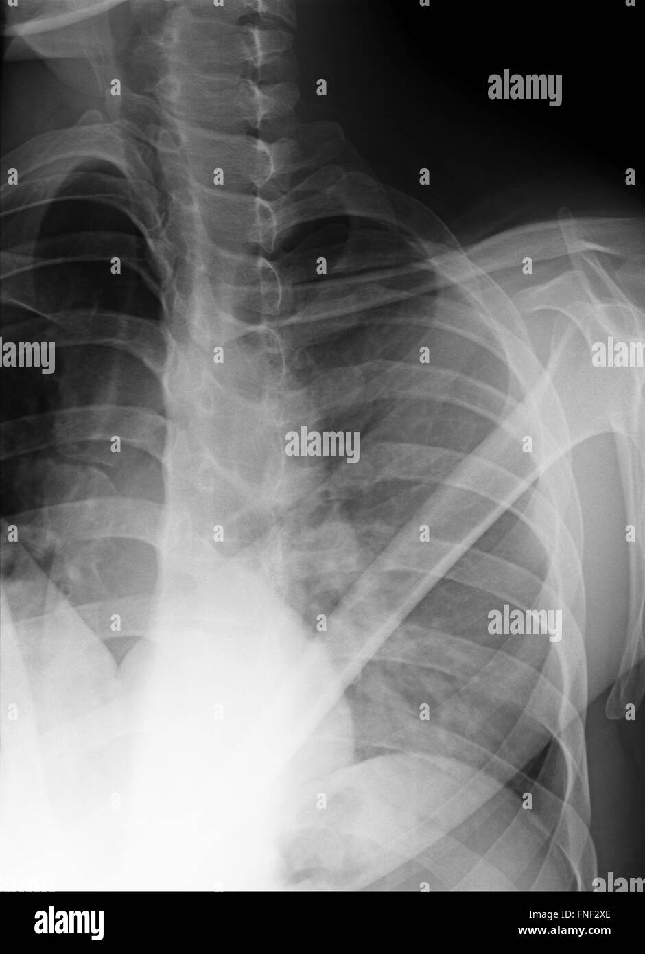 Röntgen der menschlichen Schulter Stockfotografie - Alamy