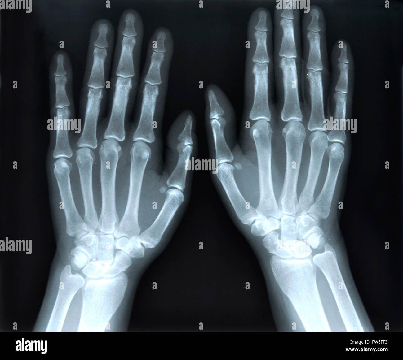 Röntgenbild von Menschenhand Stockfotografie - Alamy
