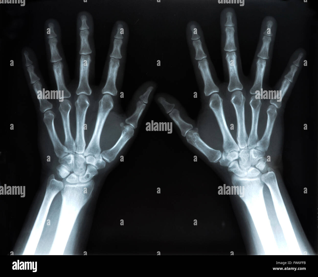 Hand anatomie röntgen -Fotos und -Bildmaterial in hoher Auflösung – Alamy