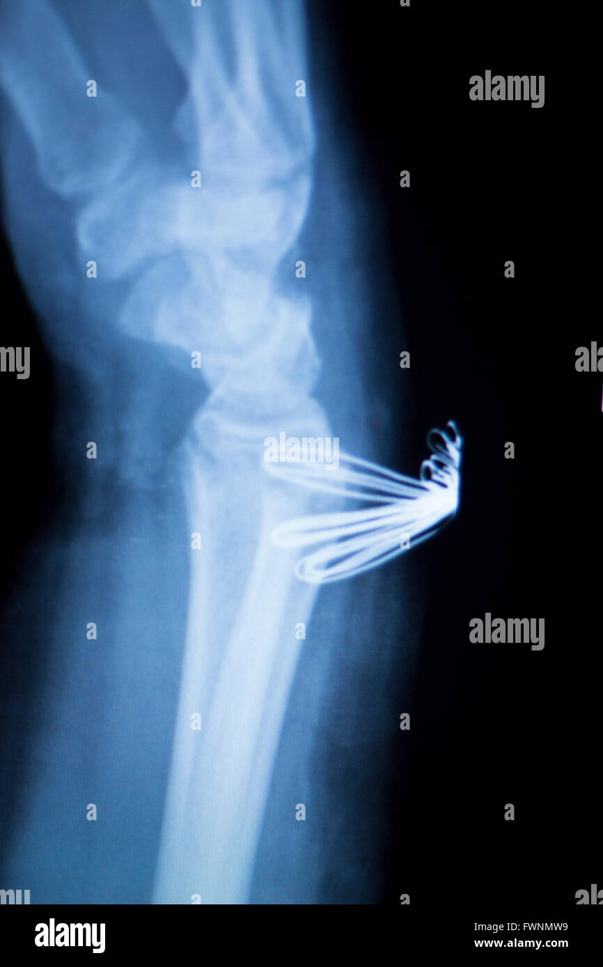 Handgelenk, hand, Unterarm und Verletzungen medizinische Röntgen-Scan ...