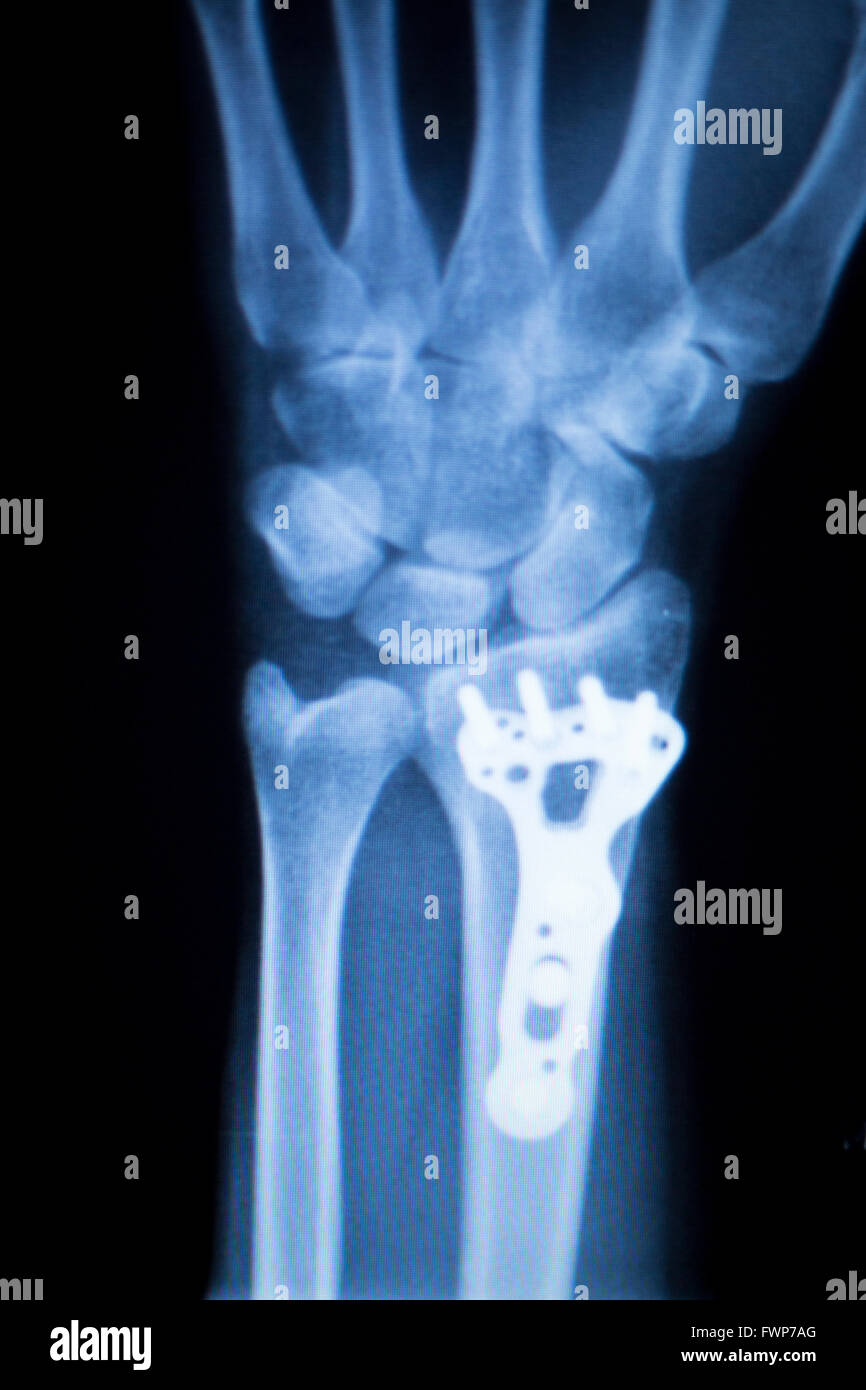 Handgelenk, hand, Unterarm und Verletzungen medizinische Röntgen-Scan ...