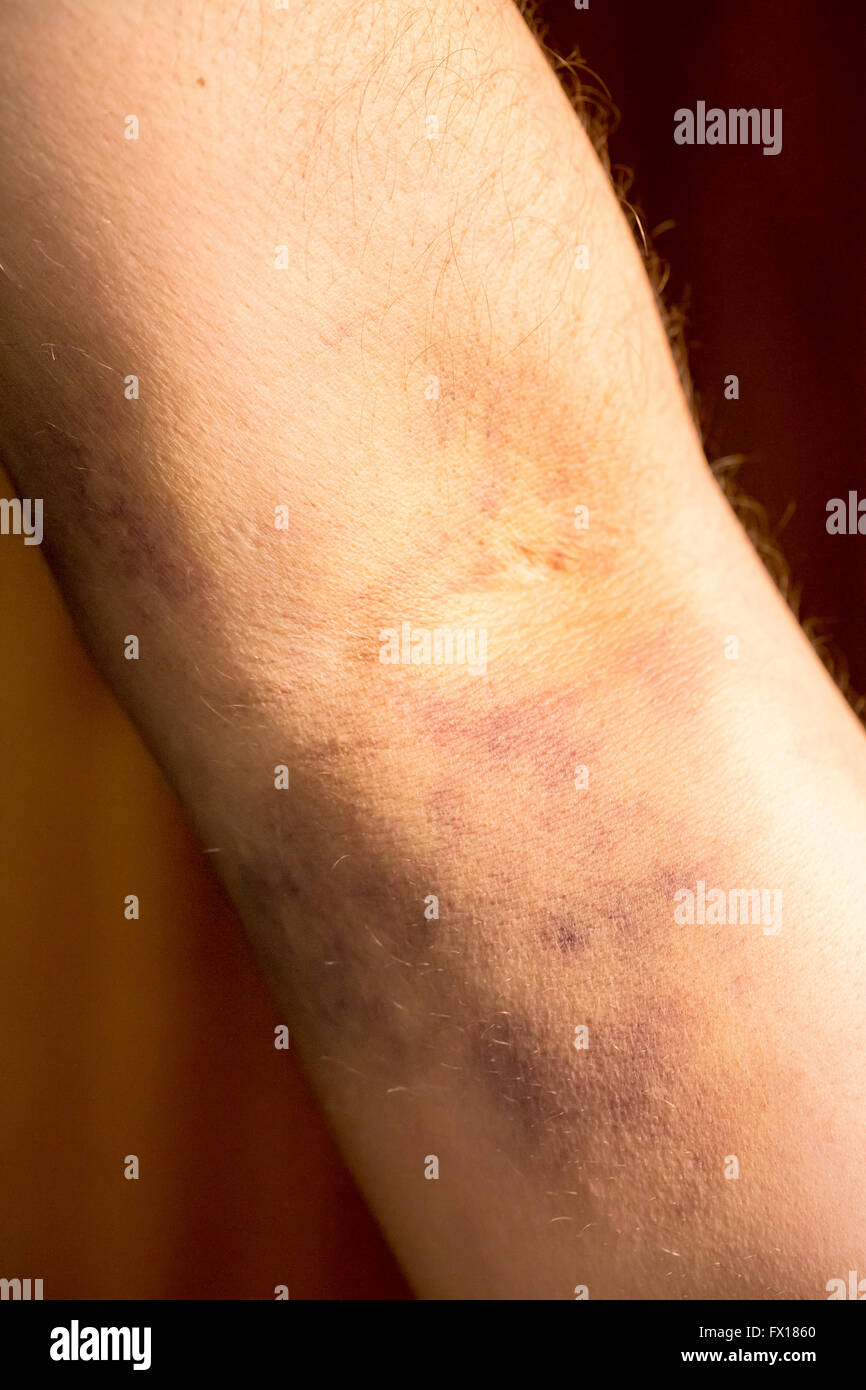 Hämatom hüfte -Fotos und -Bildmaterial in hoher Auflösung – Alamy