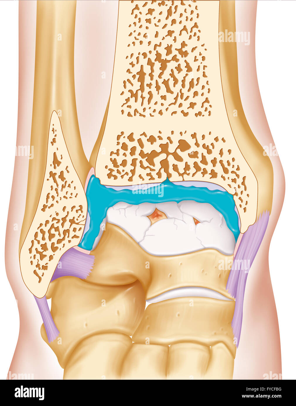 Arthrose füße -Fotos und -Bildmaterial in hoher Auflösung – Alamy