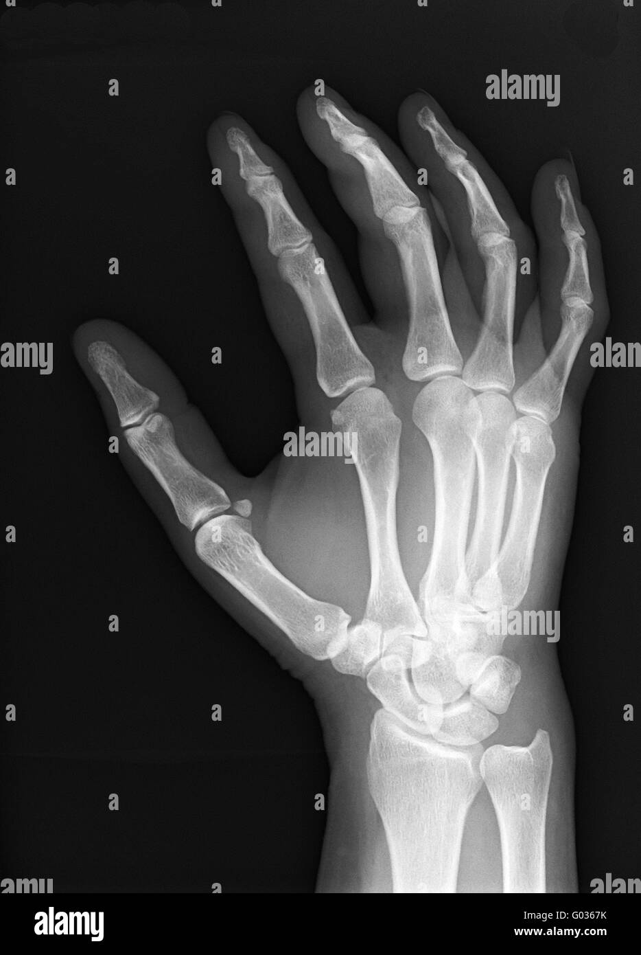 Roentgen hand -Fotos und -Bildmaterial in hoher Auflösung – Alamy