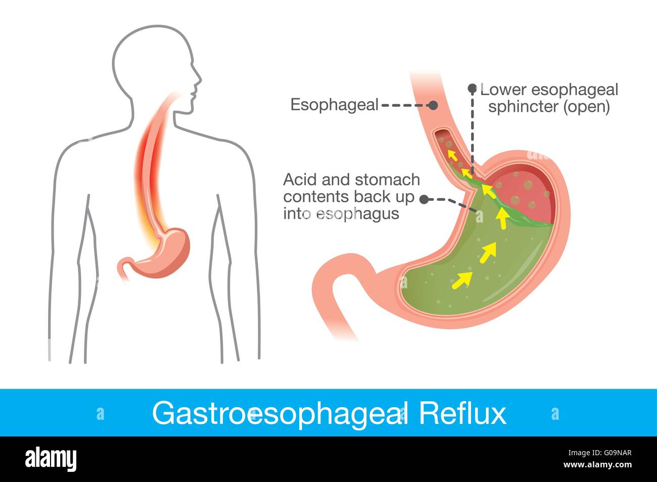 Ursache der gastroösophagealen Refluxkrankheit im menschlichen Magen ...