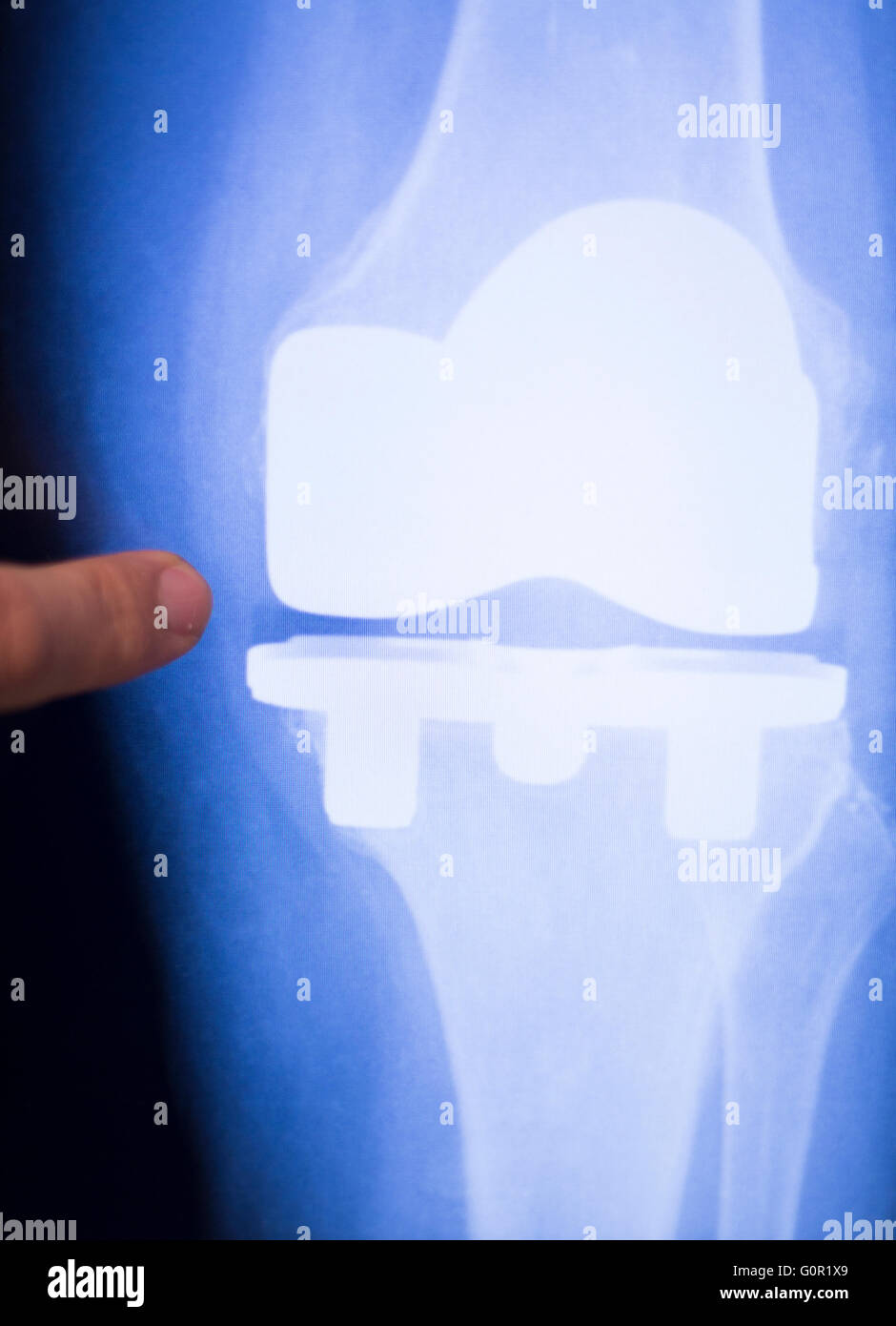 Knie- und Meniskus Verletzungen medizinische Röntgen-Scan Testergebnis ...
