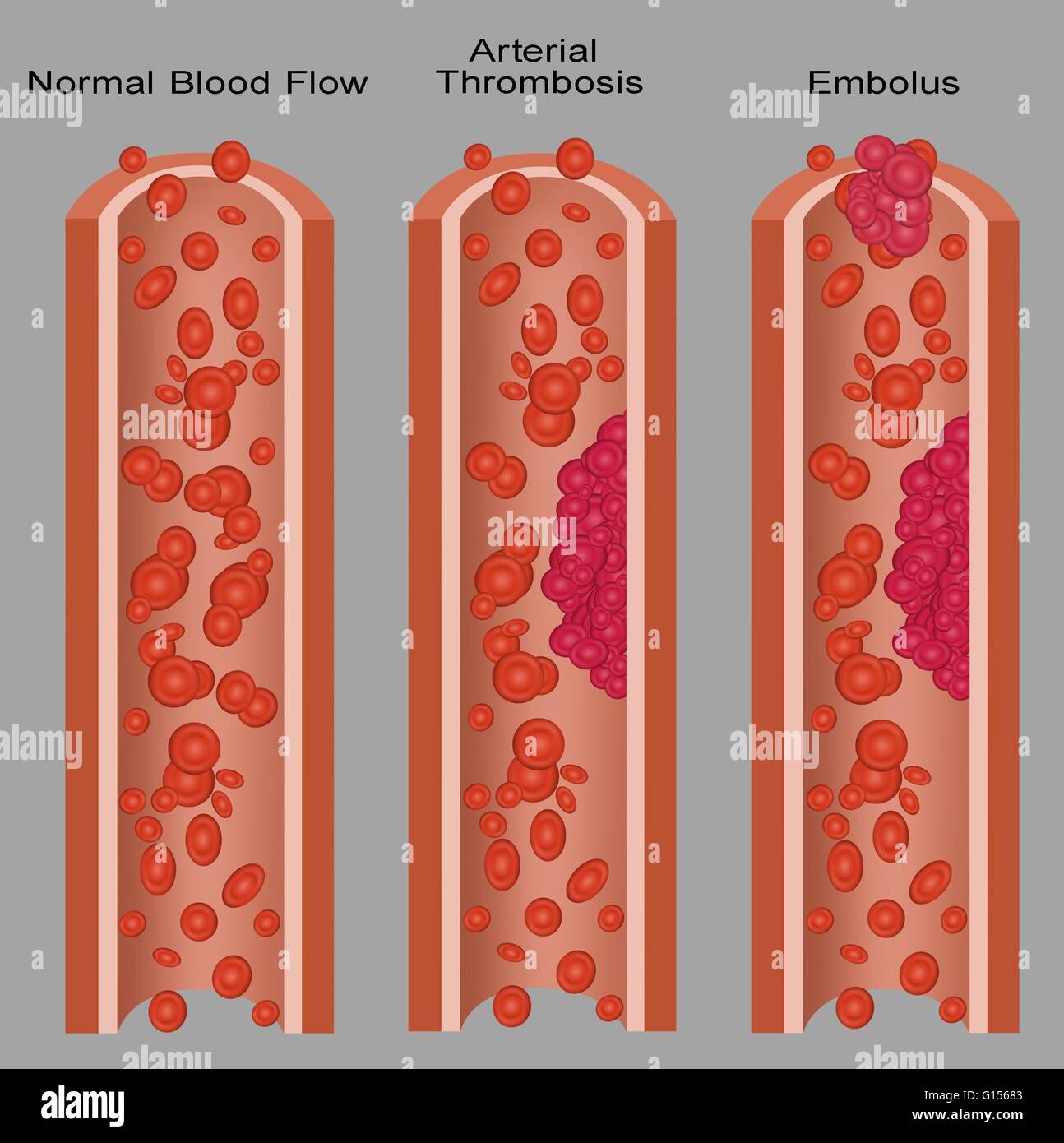 Trombose Arterial 3D Modelle Der Arteriellen Thrombose | VOKA