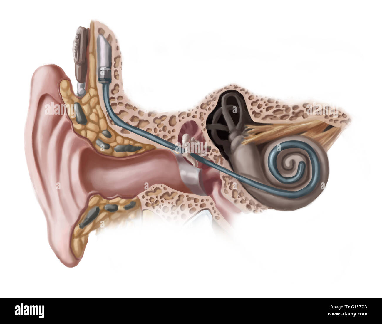 Cochlea implantat -Fotos und -Bildmaterial in hoher Auflösung – Alamy