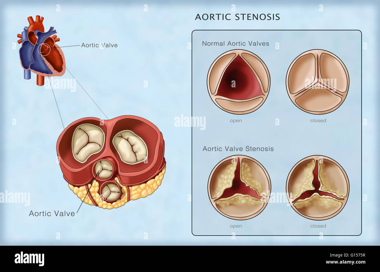 Darstellung der normalen Aortenklappen im Vergleich zu einer Verengung ...