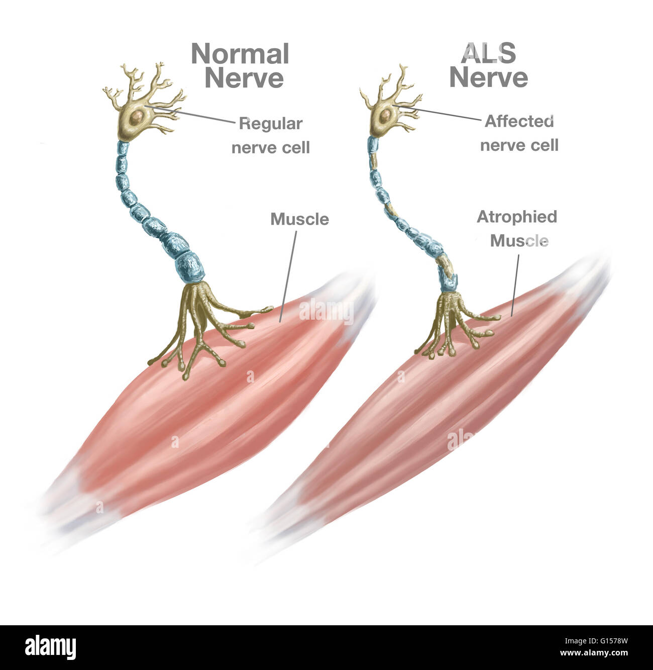 Abbildung einer normalen Nerv Struktur (links) und ein ALS betroffene ...