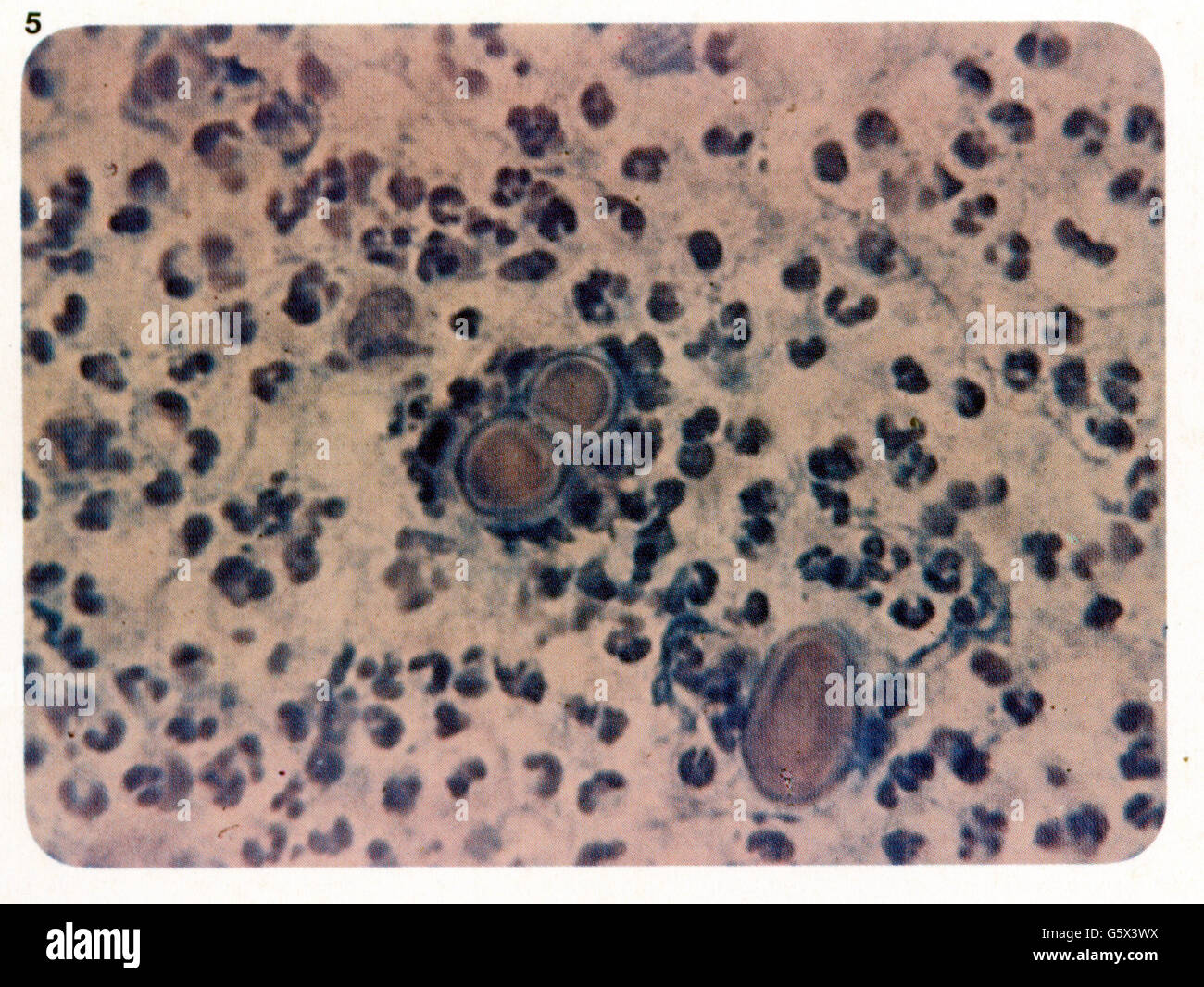 Mykotische krankheit -Fotos und -Bildmaterial in hoher Auflösung – Alamy