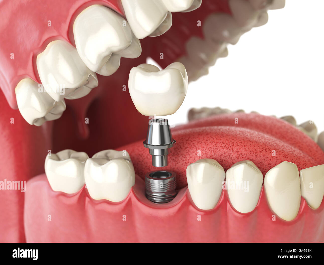 Menschlichen Zahnimplantat. Dental Konzept. Menschliche Zähne oder ...