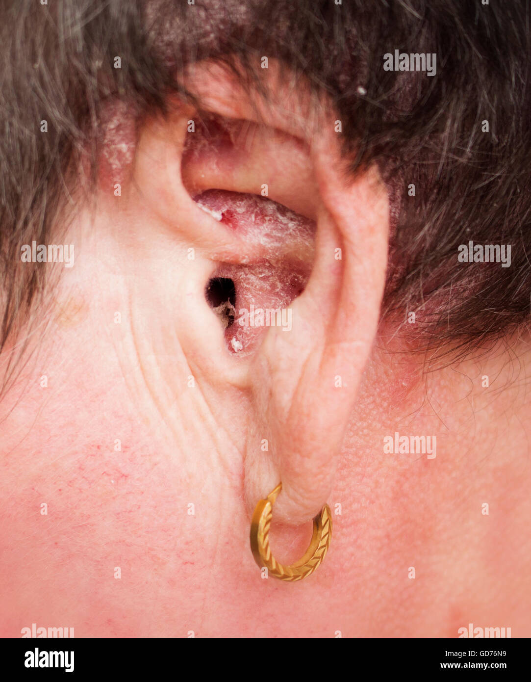 Psoriasis im ohr -Fotos und -Bildmaterial in hoher Auflösung – Alamy