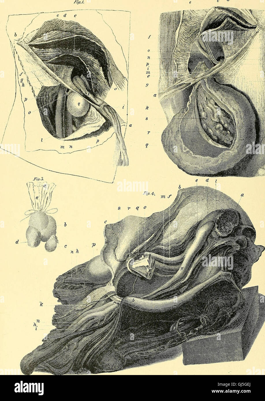 Die anatomie und chirurgische behandlung von hernien -Fotos und ...