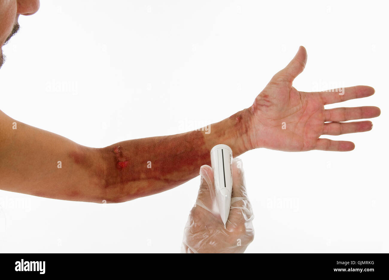 Behandlung von brandwunden -Fotos und -Bildmaterial in hoher Auflösung ...