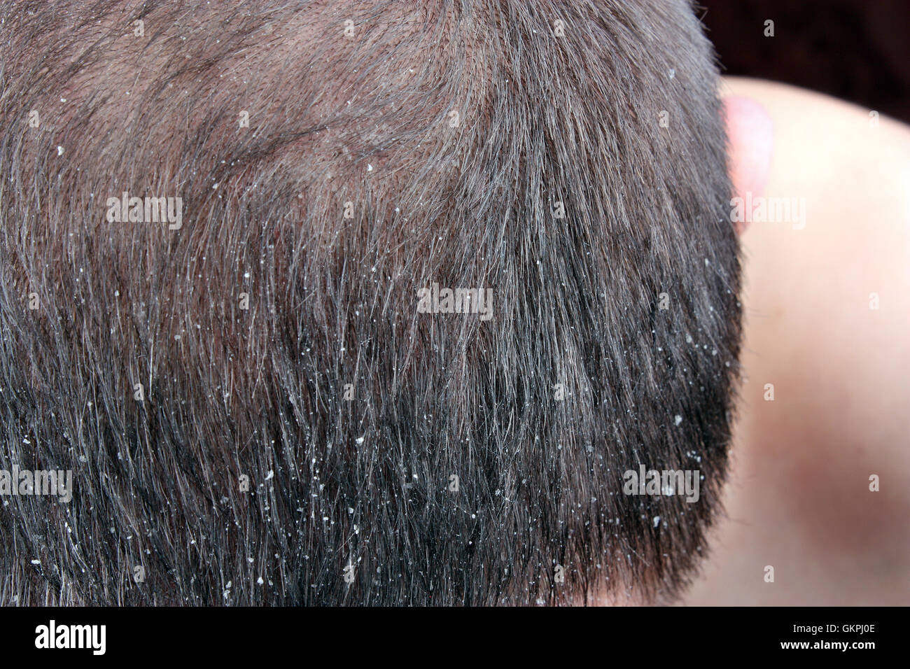 Schuppen in den Haaren. Symptome von Hauterkrankungen Stockfotografie ...