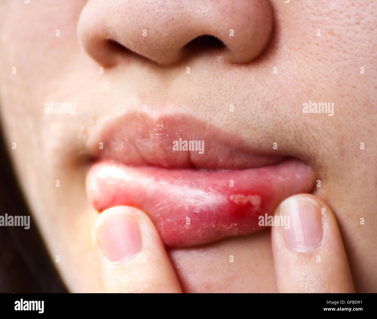 Geschwür mund -Fotos und -Bildmaterial in hoher Auflösung – Alamy