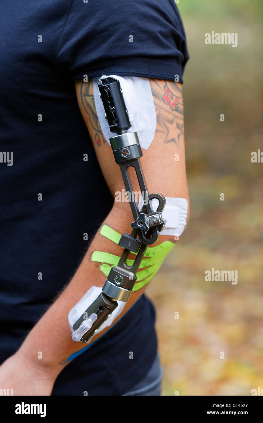 Externer Fixateur Stockfotos und -bilder Kaufen - Alamy