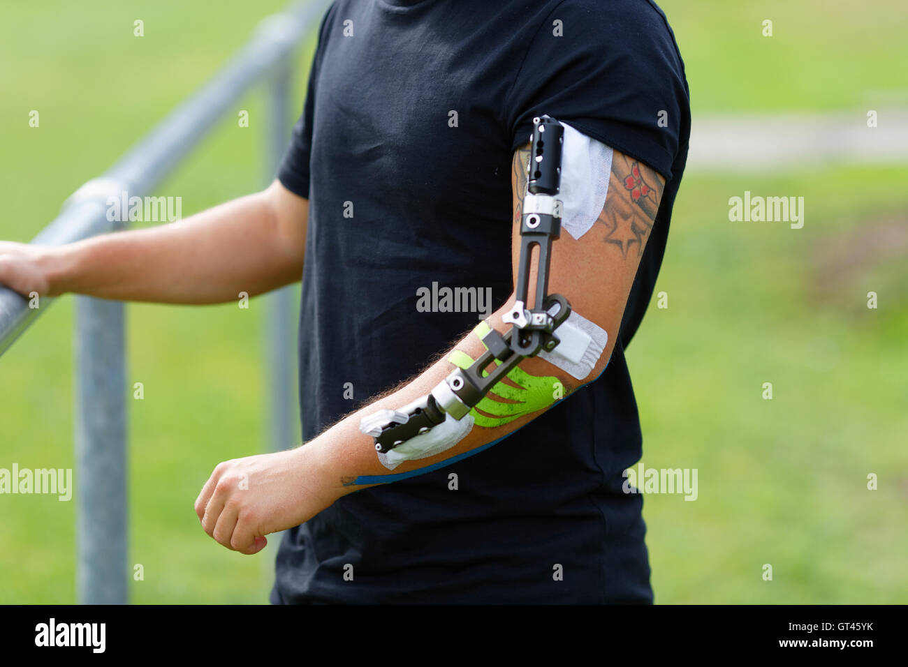 Externer Fixateur Stockfotos und -bilder Kaufen - Alamy