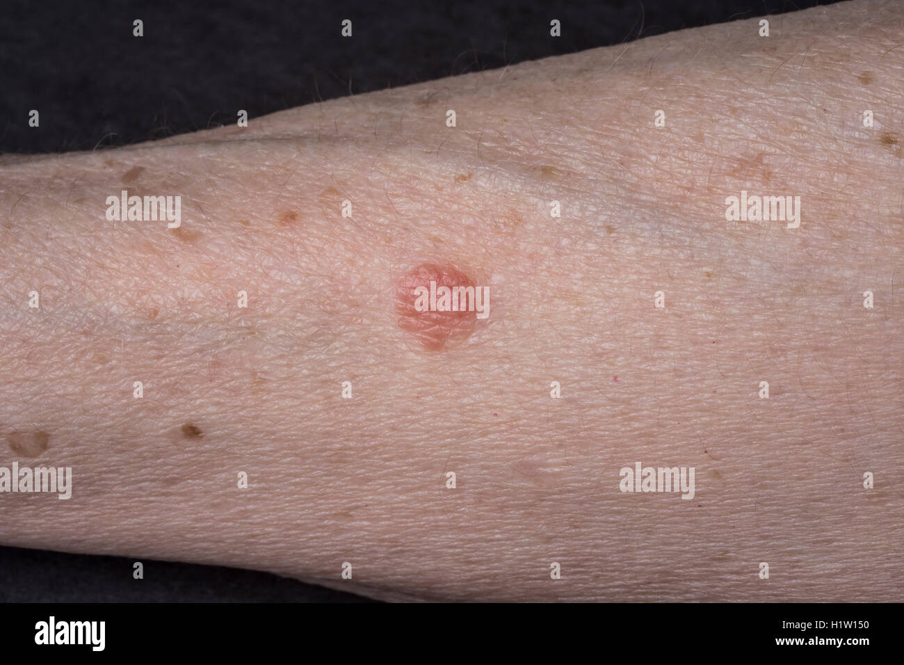 Aktinische keratose -Fotos und -Bildmaterial in hoher Auflösung – Alamy