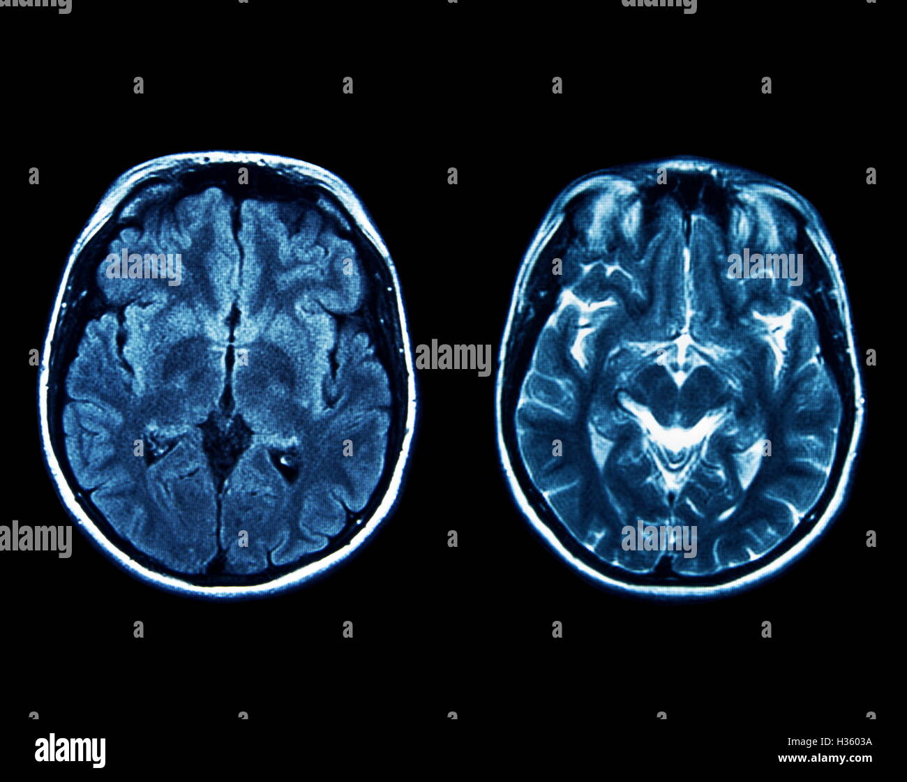 Mri scan brain Stockfotos und -bilder Kaufen - Alamy
