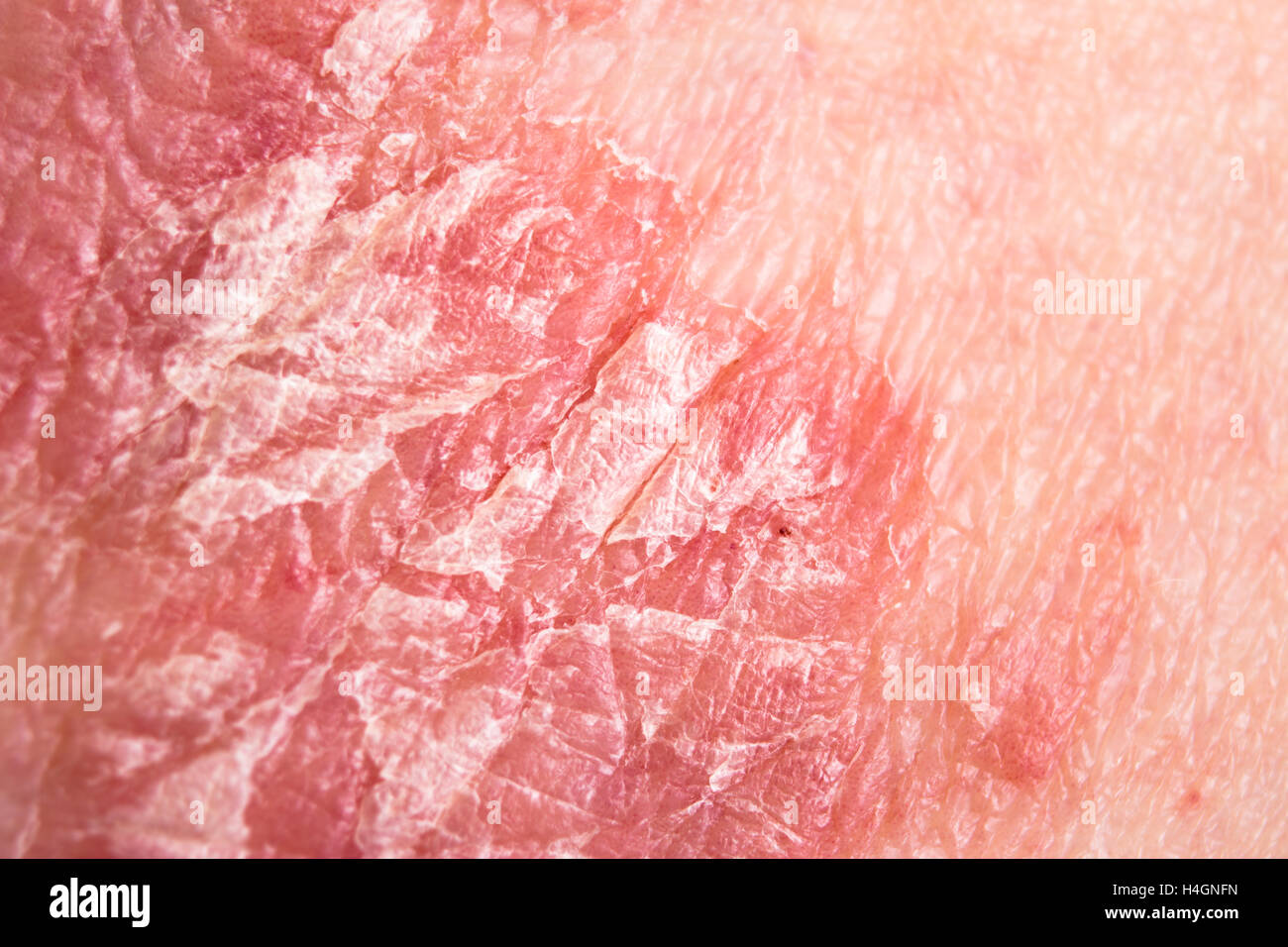 Psoriasis Vulgaris Stockfotos und -bilder Kaufen - Alamy