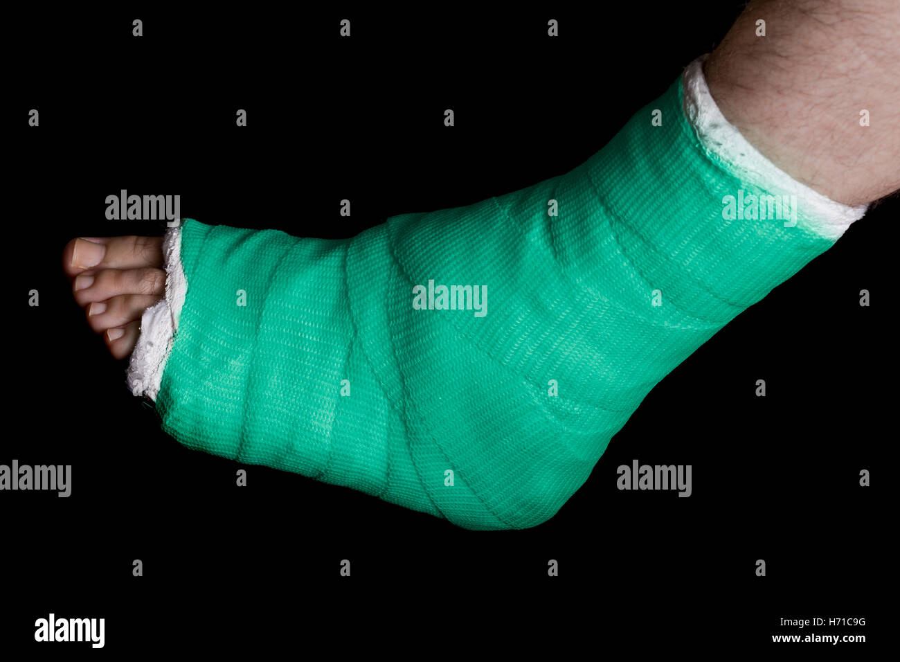 Gebrochenes bein long cast gips schwarz -Fotos und -Bildmaterial in ...