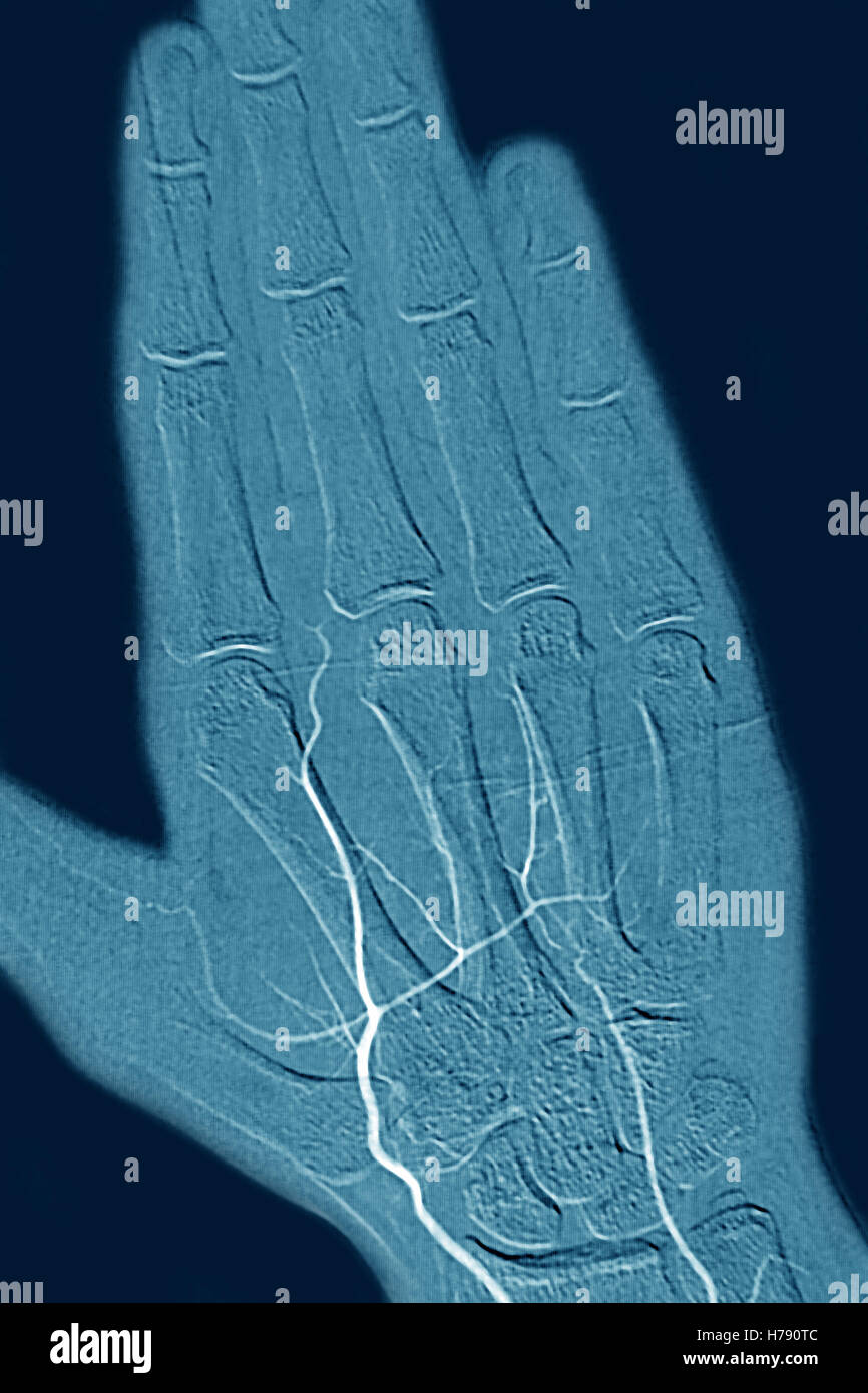 Angiography hand -Fotos und -Bildmaterial in hoher Auflösung – Alamy