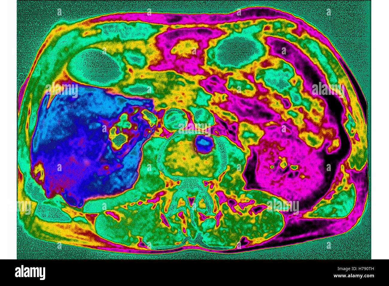 Ct scan der leber -Fotos und -Bildmaterial in hoher Auflösung – Alamy