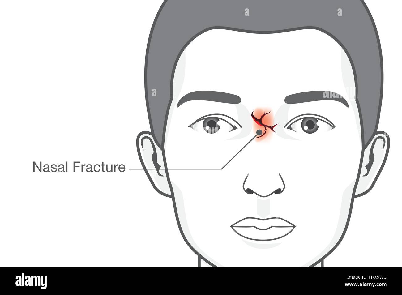 Nasal fracture Stock-Vektorgrafiken kaufen - Alamy