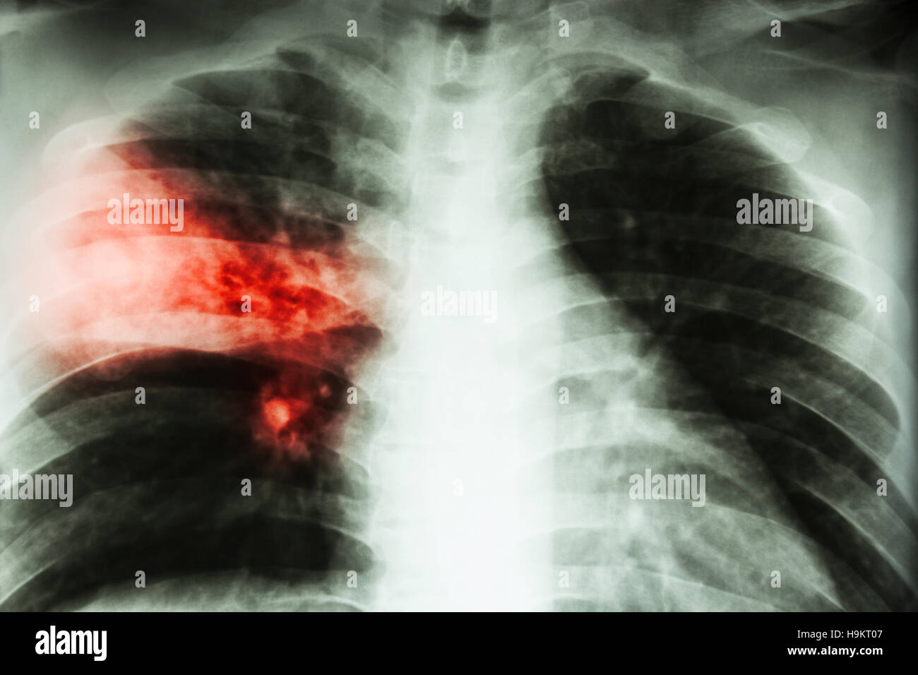 Mycobacterium tuberculosis -Fotos und -Bildmaterial in hoher Auflösung ...