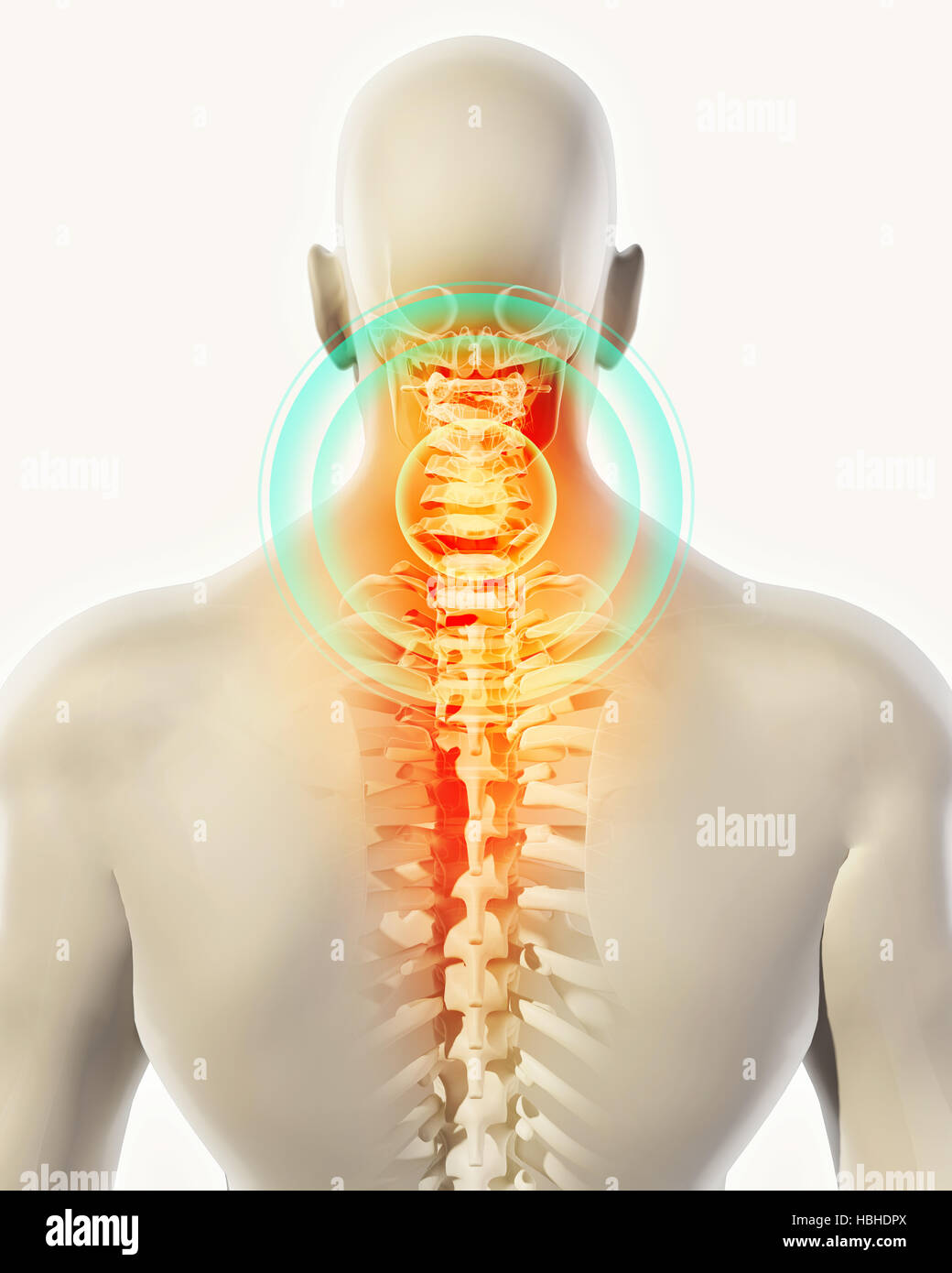 3D Illustration, Nacken schmerzhaft - Cervica Wirbelsäule Skelett ...