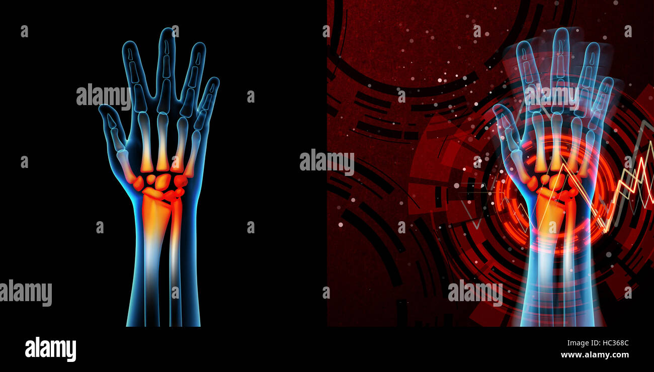 3D gerenderten Anatomie-Illustration - Hand-Schmerzen Stockfotografie ...