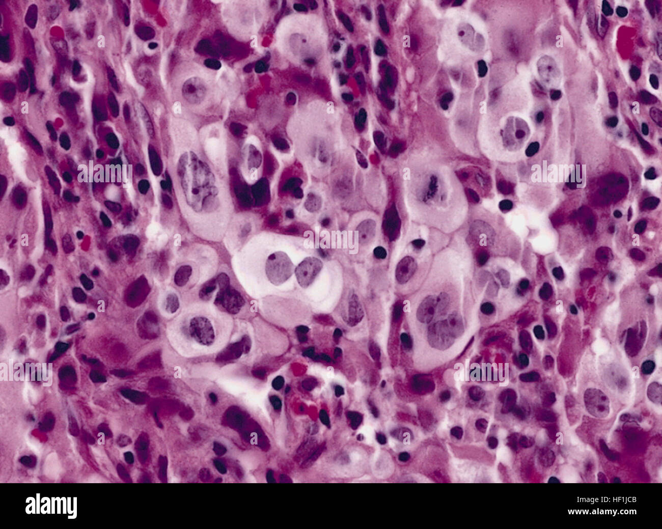 Großzellige Karzinome der Lunge Stockfotografie - Alamy