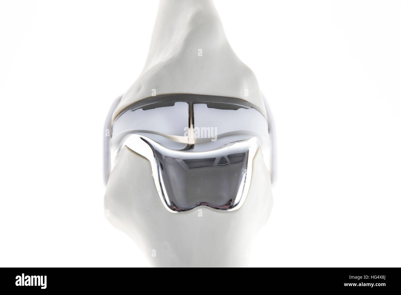 Knieprothese, Knieendoprothese oder gemeinsame Knieprothese, auf einen ...