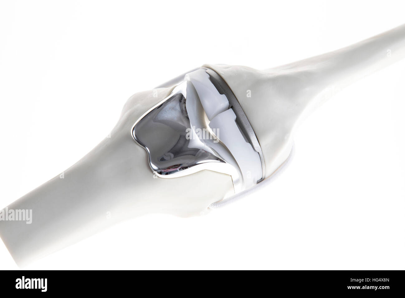 Knieprothese, Knieendoprothese oder gemeinsame Knieprothese, auf einen ...