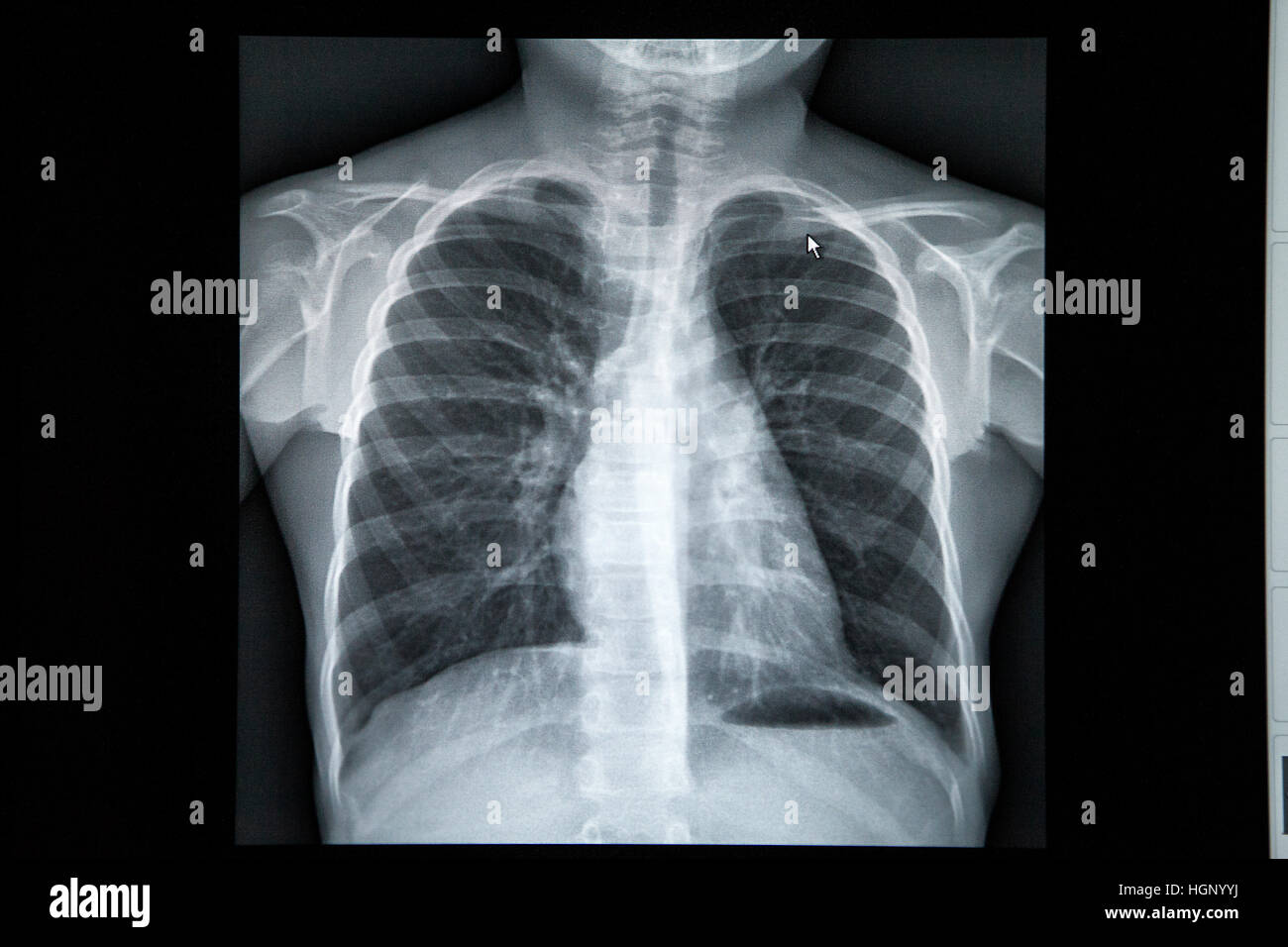 Normal pulmonary radiography -Fotos und -Bildmaterial in hoher ...