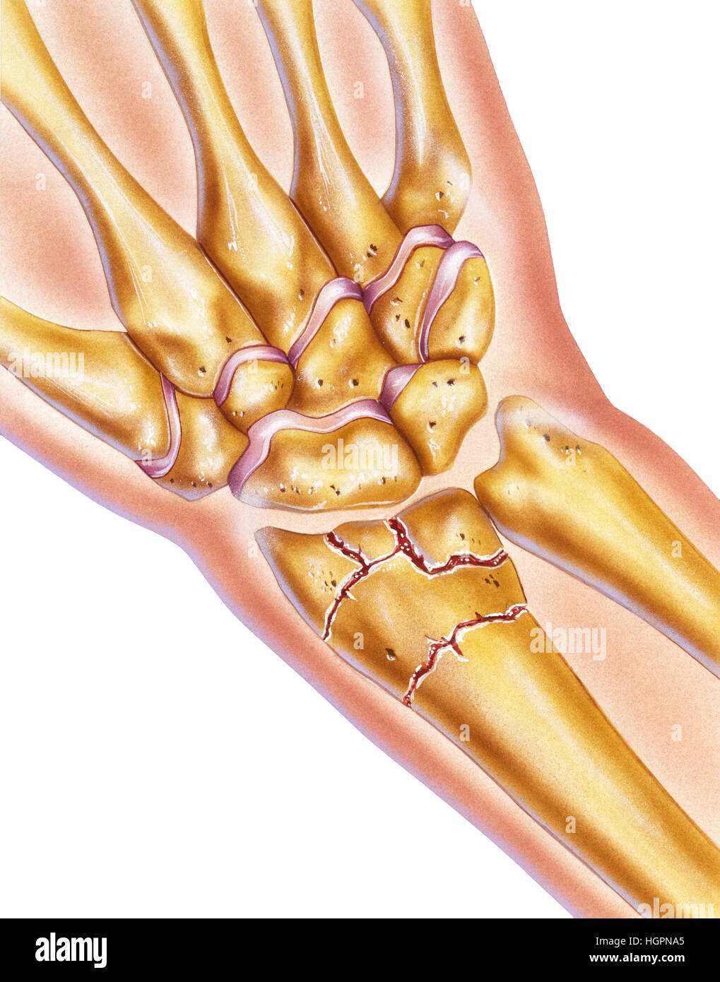 Hand und Handgelenk gebrochen - Radius Knochen gebrochen ...