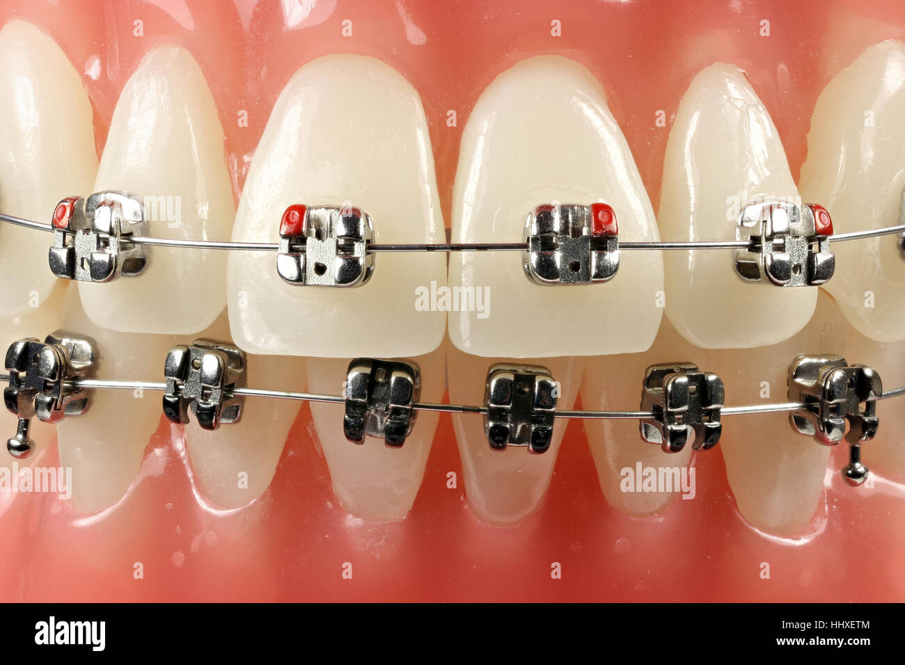 Realigning teeth -Fotos und -Bildmaterial in hoher Auflösung – Alamy