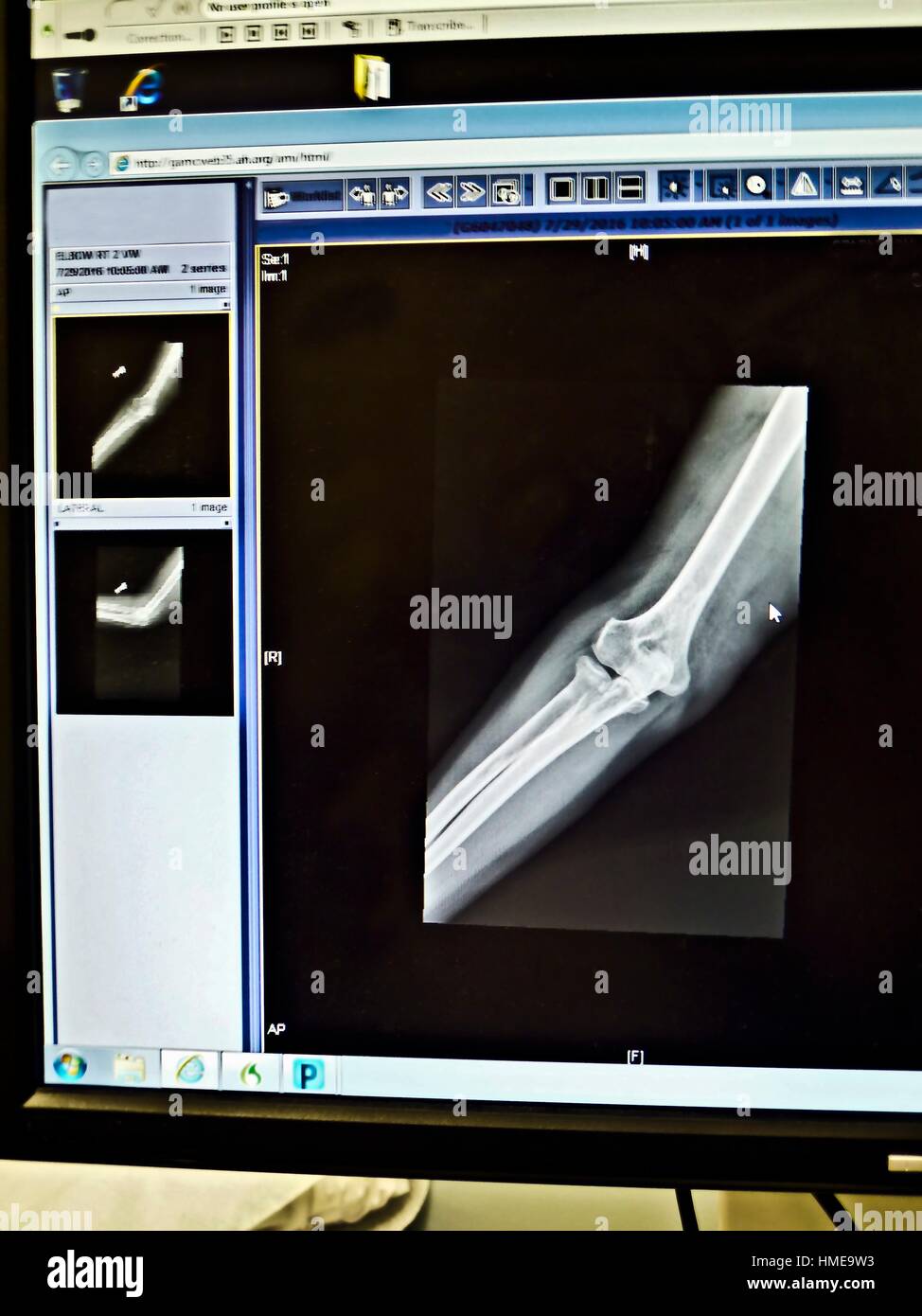 Elbow x ray -Fotos und -Bildmaterial in hoher Auflösung – Alamy