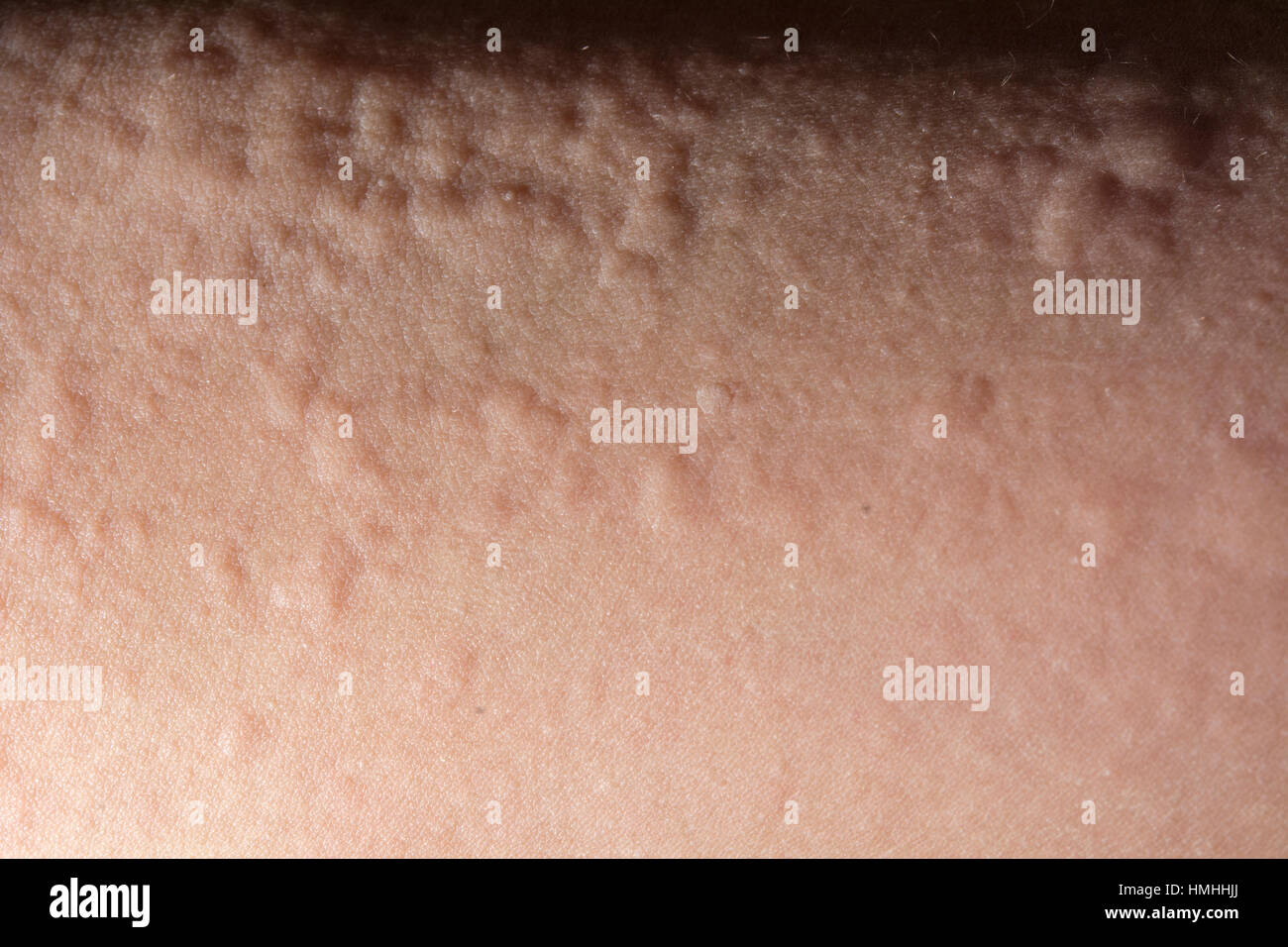 Brennnessel dermatitis -Fotos und -Bildmaterial in hoher Auflösung – Alamy