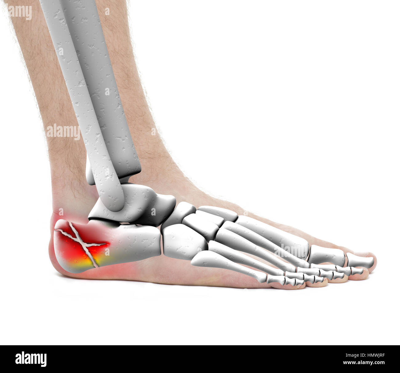 Calcaneus fracture -Fotos und -Bildmaterial in hoher Auflösung – Alamy