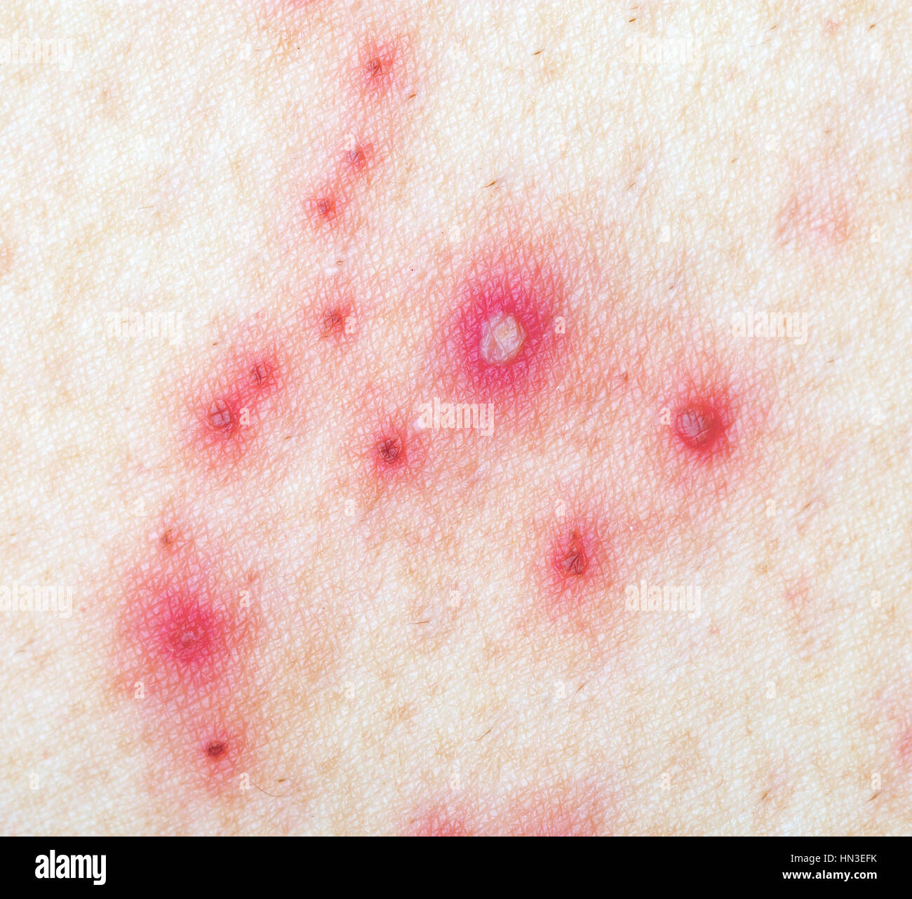Herpes Zoster Stockfotos & Herpes Zoster Bilder - Alamy