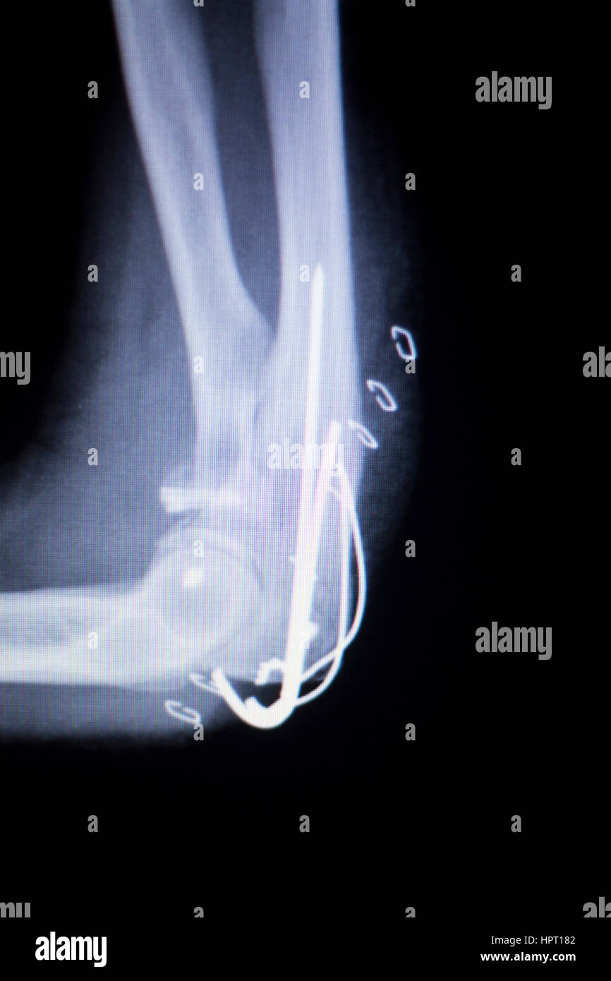 Ellenbogen gemeinsame Titanium Metall moderne Implantat Röntgen-Test ...