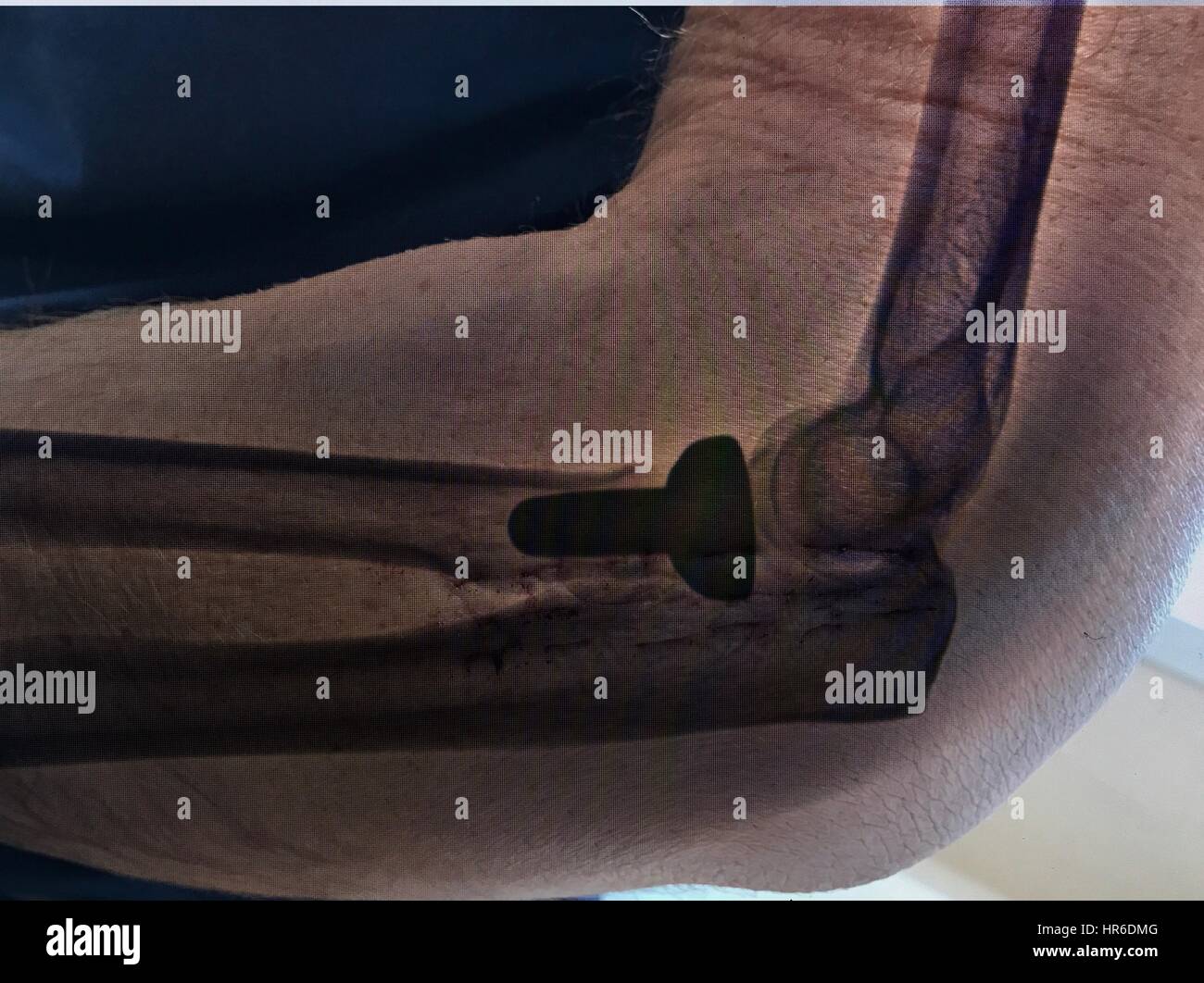 Ellenbogen gesundheit -Fotos und -Bildmaterial in hoher Auflösung – Alamy