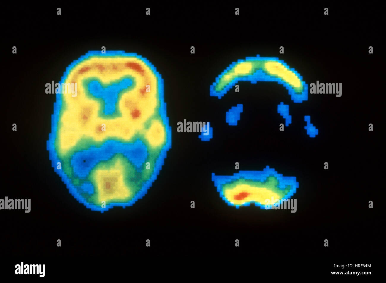 PET-Scans des Gehirns Normal und Alzheimer Stockfotografie - Alamy
