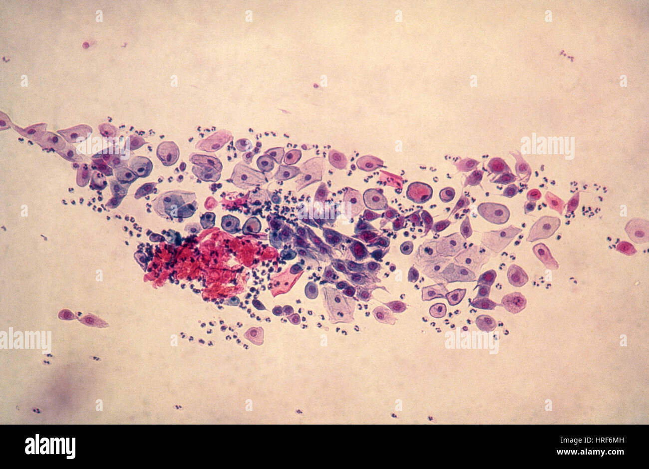 Pap test gebärmutterhalskrebs -Fotos und -Bildmaterial in hoher ...